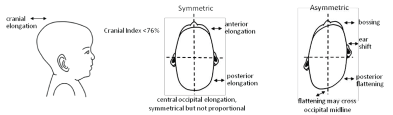 Nonsynostotic deformational plagiocephaly: Understand, screen, and ...